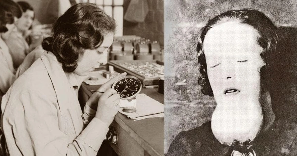 Radium Girls Were Badly Poisoned By Radium Jaw Disease