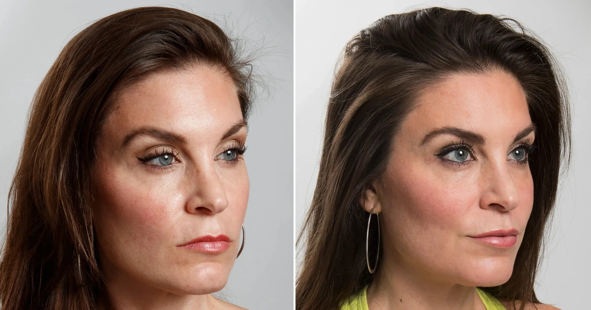 RBF Surgery - Treatment Of Resting Bitch Face