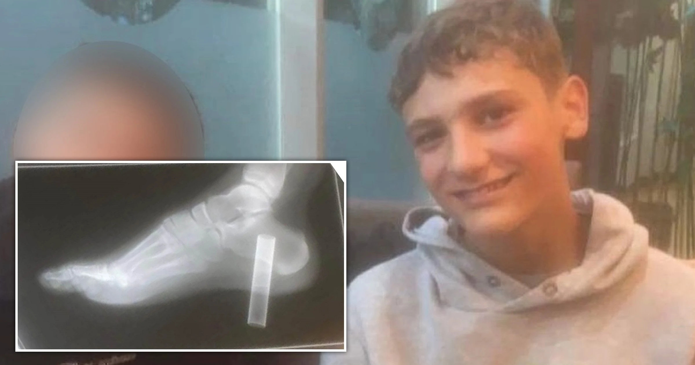 Boy Nearly Lost His Foot After Being Impaled By Plastic Vape
