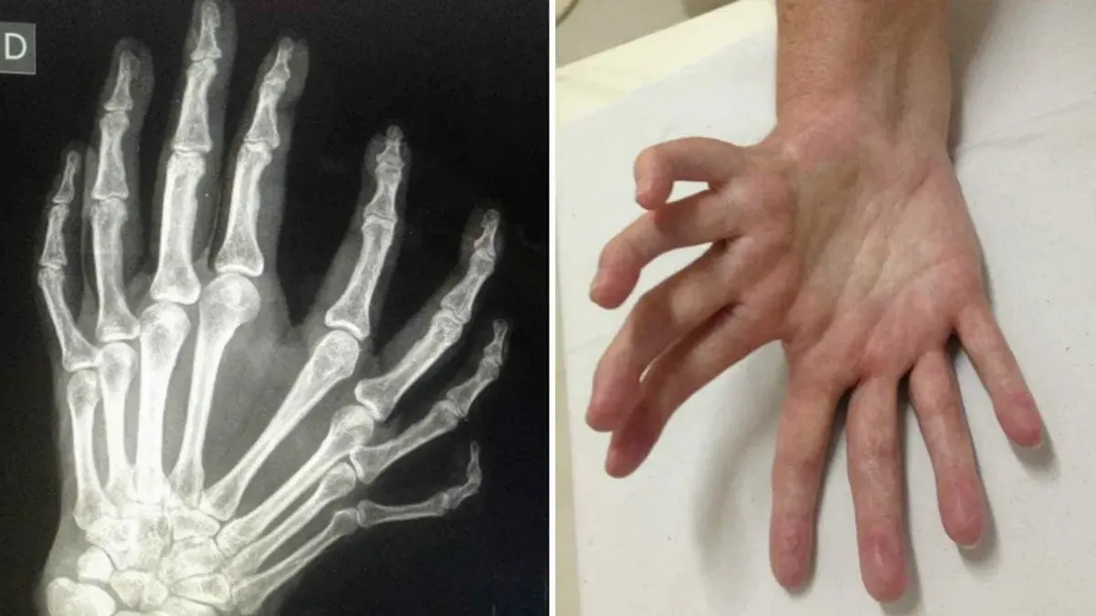 Mirror Hand Syndrome - A Rare Condition That Creates Symmetrical Hands