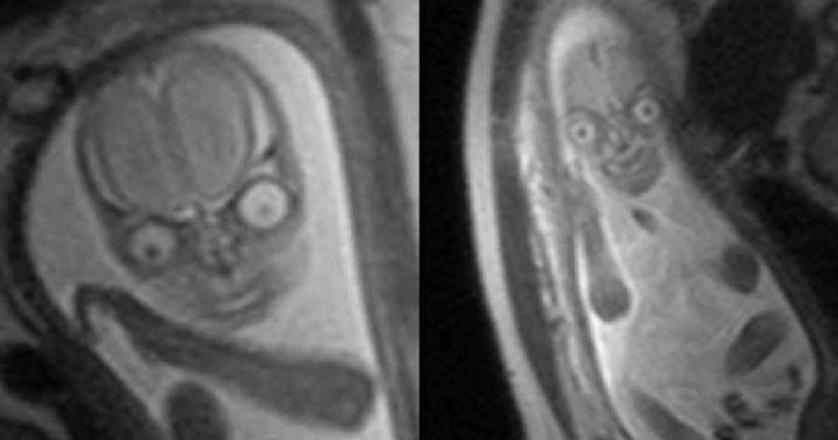 People Are Horrified After Seeing MRI Images Of An Unborn Baby