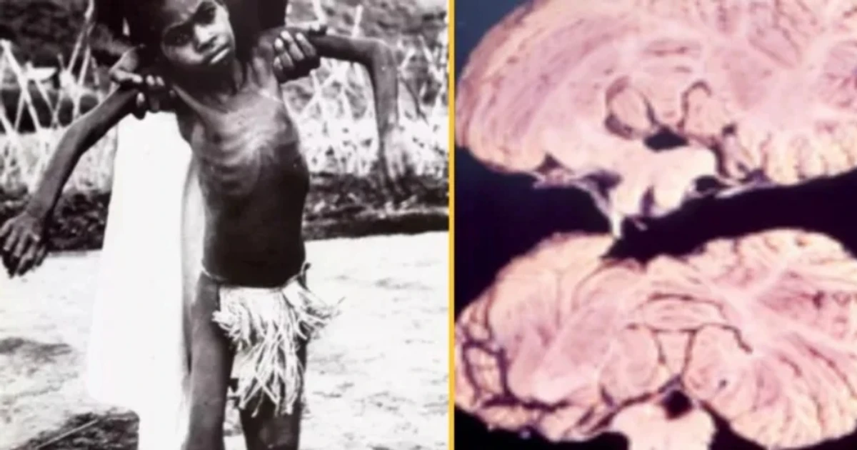 World's Deadliest Disease "Kuru" Has A Fatality Rate Of Almost 100%